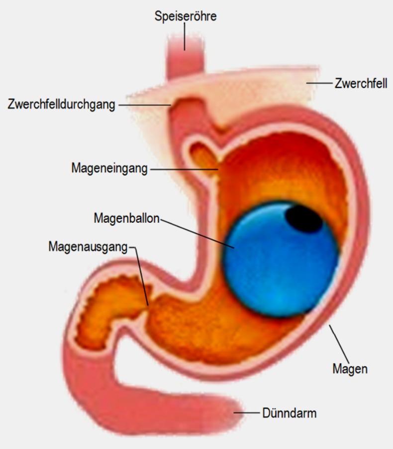 MeineMagenOP - Mein Weg in ein neues, gesünderes Leben - OP- Varianten